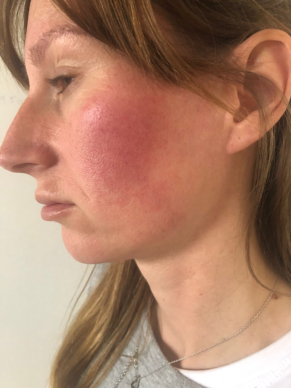 Rosacea's Story: PRP Skin Therapy Results - CMG